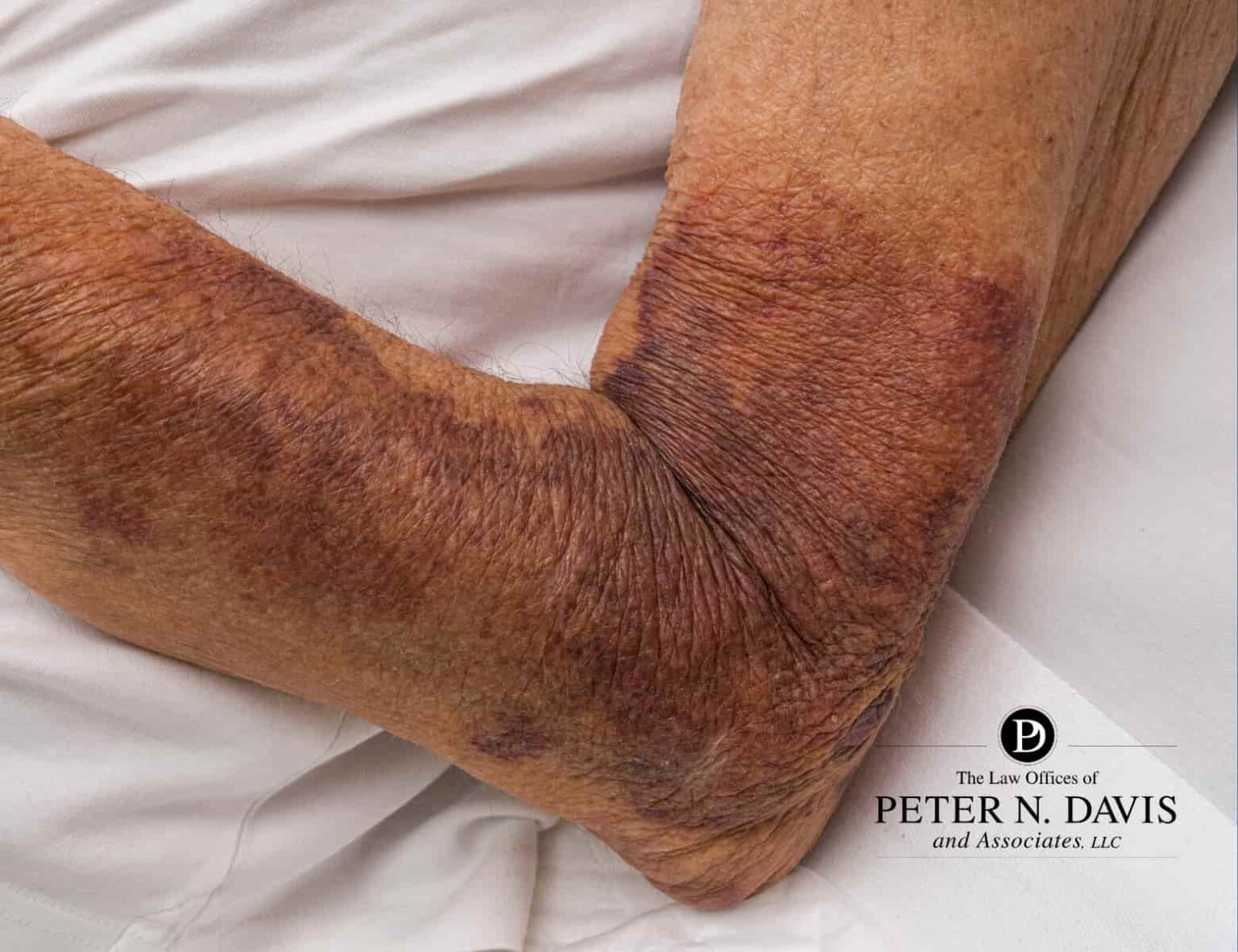 What to Do if You Suffer Soft Tissue Damage After Car Accident in NJ
